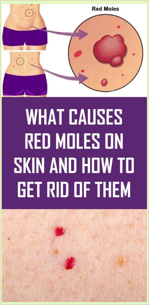 WHAT DO THE RED MOLES ON THE BODY MEAN? - Garden By Yourself